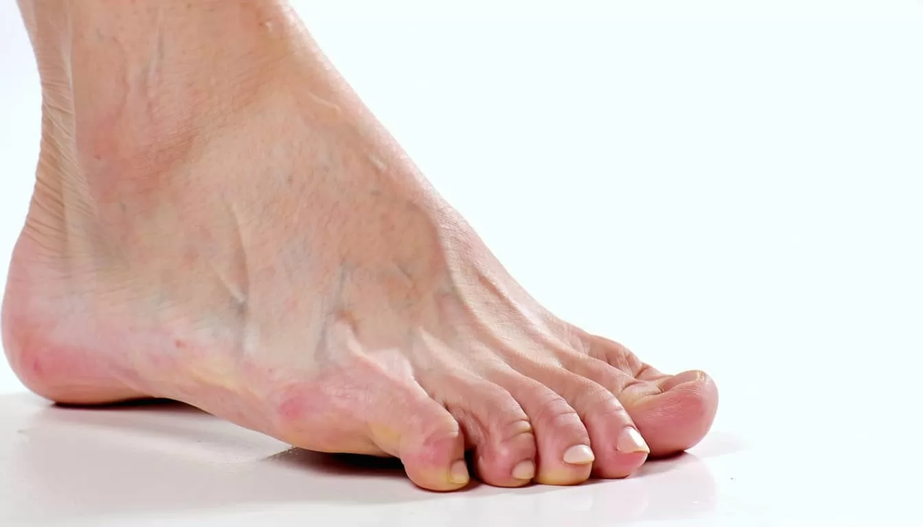 Toe Joint Replacement Recovery Time → Get Legal Help